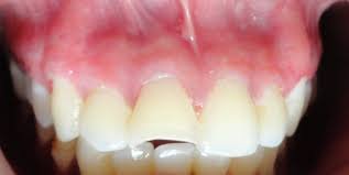 How to get rid of gum pigmentation? - Dental Planet